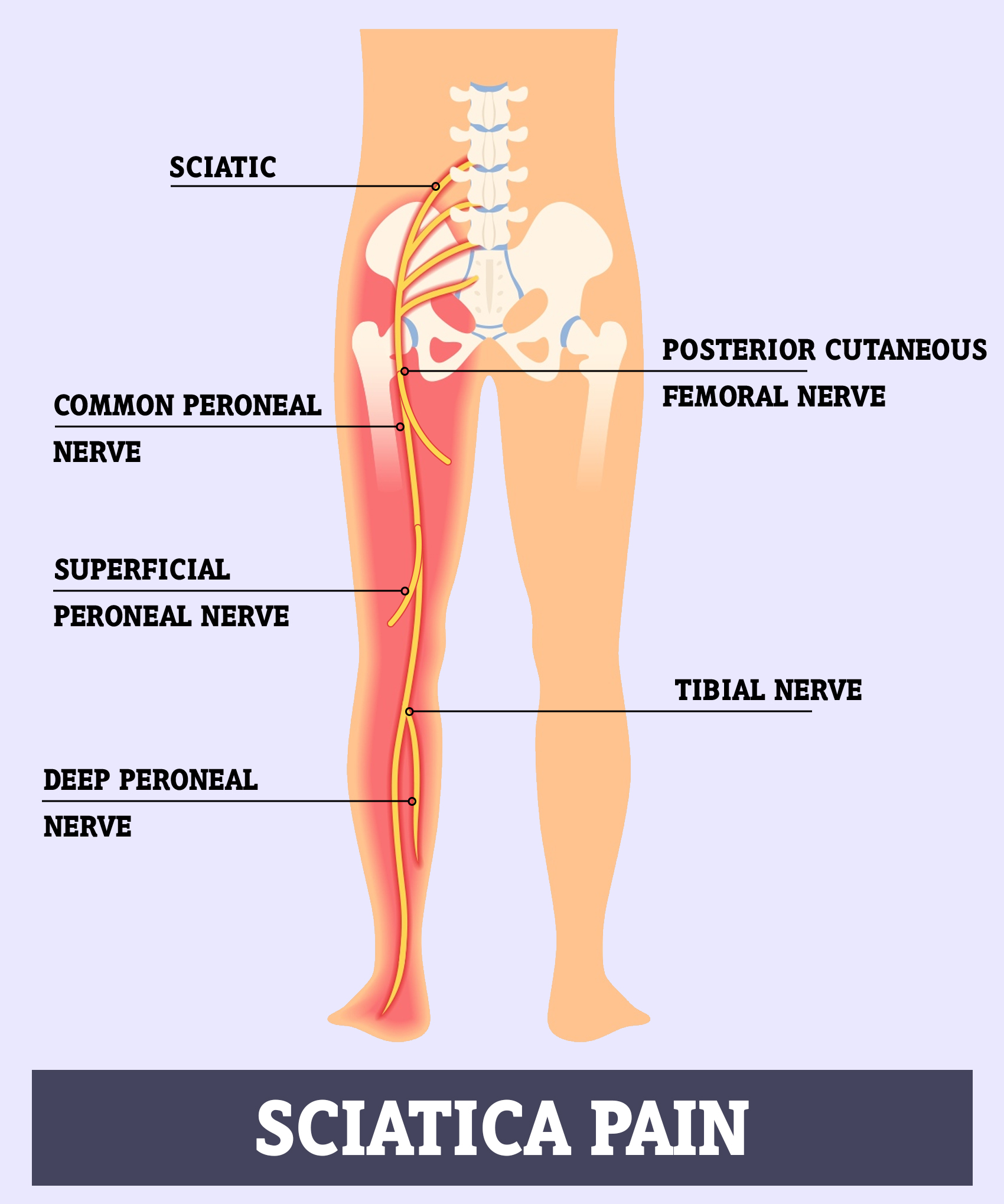 Best Ways To Treat Sciatica pain - A Comprehensive Guide
